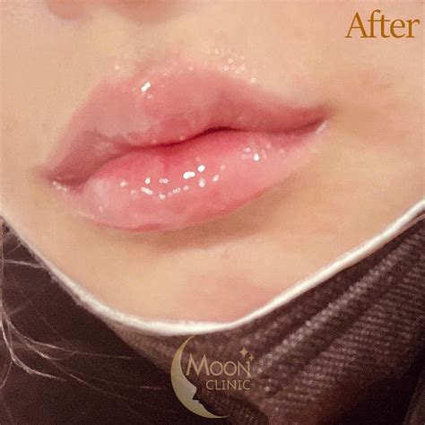 문클리닉 예쁜입술은 문클리닉 입술필러 의 정석 문클의 실제 고객님 립리뷰 감사합니다 💛 Facebook
