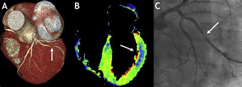 dynamic ct myocardial perfusion imaging journal of cardiovascular
