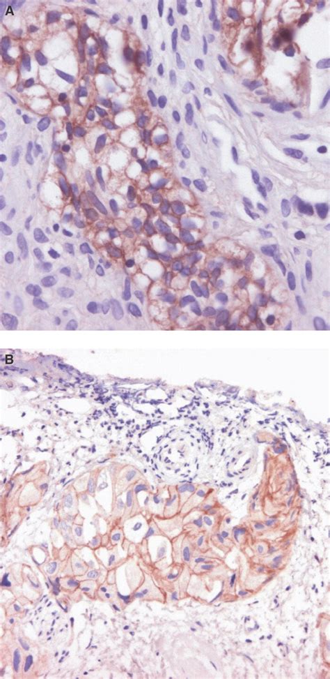 Immunohistochemical Detection After The Development Of AIPC Of A