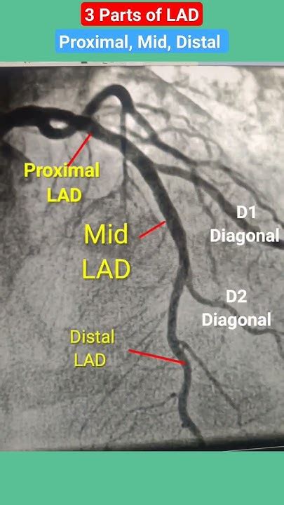 Proximal Mid Distal Lad Left Anterior Descending Artery Angiography Shorts Youtube
