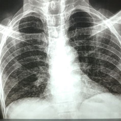 Chest X Ray Diffuse Miliary Image Download Scientific Diagram