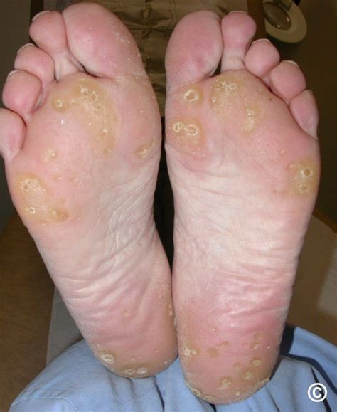 Punctate Keratosis