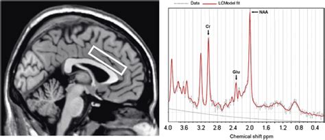voxel placement in left dorsal anterior cingulate cortex for localized