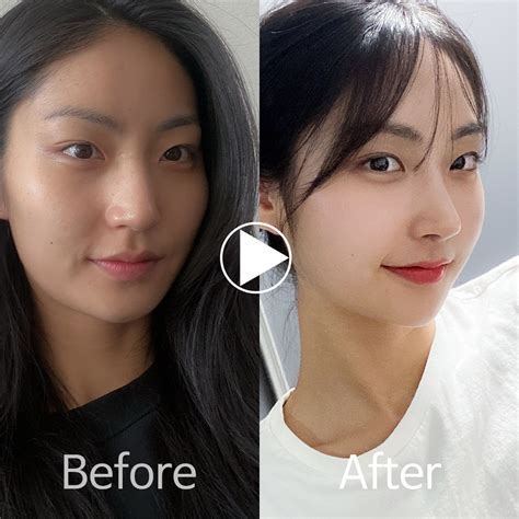 앤플러스의원 코성형 코수술 코수술비용 코성형가격 코성형외과