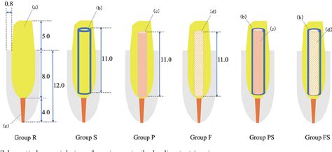 Figure 2 From Evaluation Of Composite Resin Core With Prefabricated Polyetheretherketone Post On