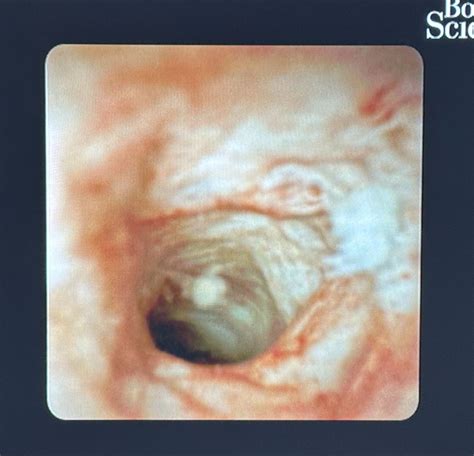 Ercp Cholangioscopy Spyscope Cholangiocarcinoma Amir Butt Md Ercp Cholangioscopy Spyscope Cholangiocarcinoma Amir Butt Md