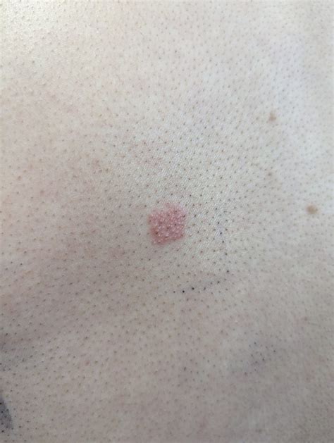 Patch Testing The Basics Robin Lewallan M D Board Certified Dermatologist Newport Beach