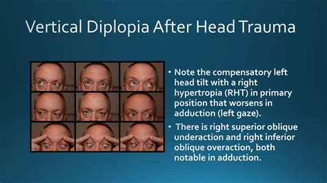 Disorders Of The Trochlear Nerve Pptx