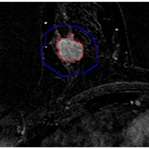 semi automatic segmentation result of the breast lesion based on the