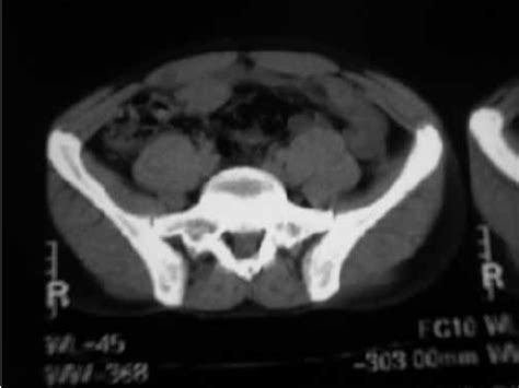 Hematoma View Inside The Right Rectus Sheath In Abdominal Computerized Download Scientific