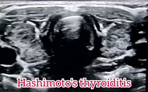 Daniel Ben Mordechay Auf Linkedin Ultrasound Hashimoto Thyroiditis