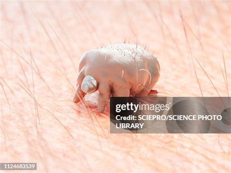 Illustration Of A Scabies Mite On Human Skin High Res Vector Graphic