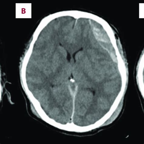 Head Computed Tomography Ct Before And After Emergency Craniotomy