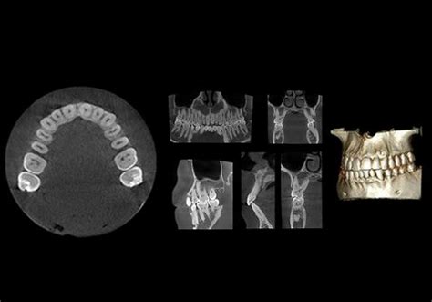Anatomy Of The Teeth Annotated Dental Cbct E Anatomy