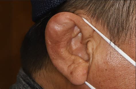 Serous Fluid Pimple