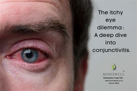 A Comprehensive Guide To Conjunctivitis Mindwell Clinic