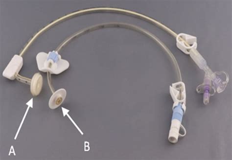 Observed High Incidence Of Buried Bumper Syndrome Associated With Freka