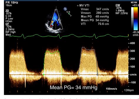 Mitral Stenosis