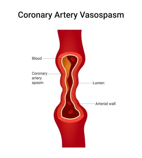 Premium Vector Causes Of Coronary Artery Vasospasm