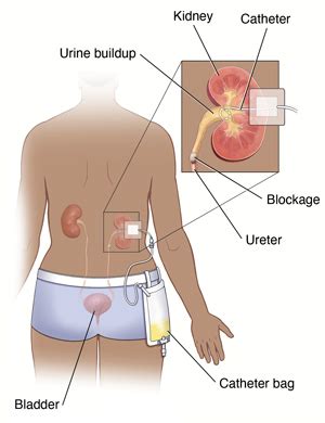 Percutaneous Nephrostomy Saint Lukes Health System