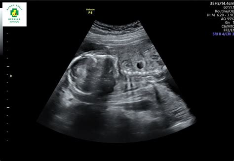 Ut L Pada Usg At Harry Leslie Blog