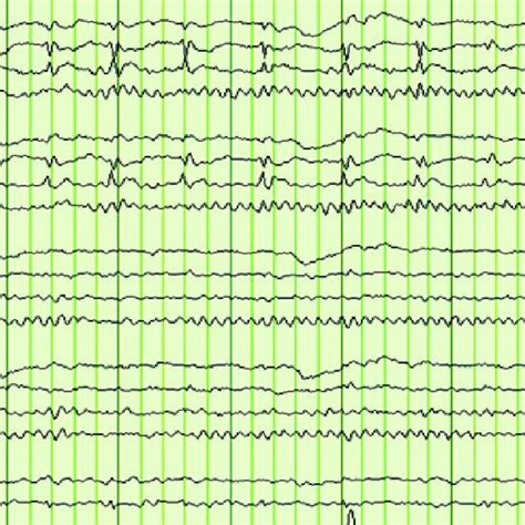 Hypnagogic Hypersynchrony A Normal Eeg Variant [42] Download Scientific Diagram