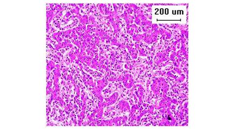 Video Fluorescent Laparoscopic Central Hepatectomy For Liver Cancer Using Indocyanine Green