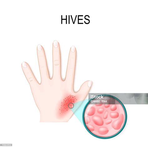 Skin Rash Hives Or Urticaria Hand Of The Patient Stock Illustration