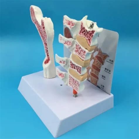 Comparative Model Of Healthy And Dynamic Osteoporosis In Osteoporosis Spinal And Femoral