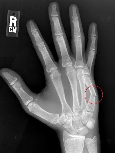 Current Management Of Metacarpal Fractures Hand Clini