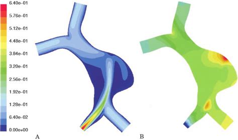 Computational Fluid Dynamics Results In The Patient Specific Geometry
