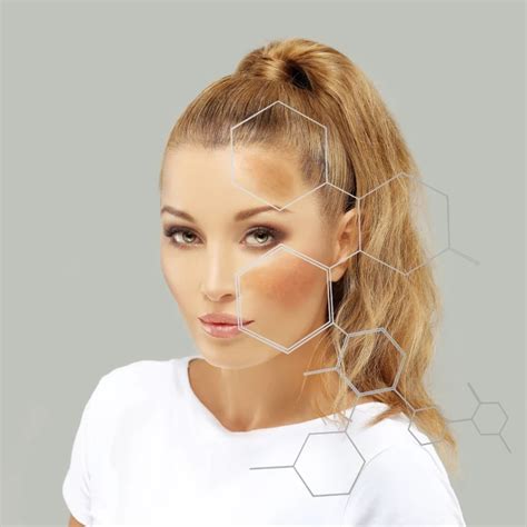 Melasma Treatment And Causes Reborn Skin Clinic