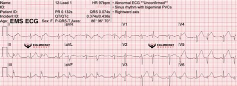 Stat Ecg Diagnoses What To Do When The St Segment Elevation In Presumed Stemi Resolves Before
