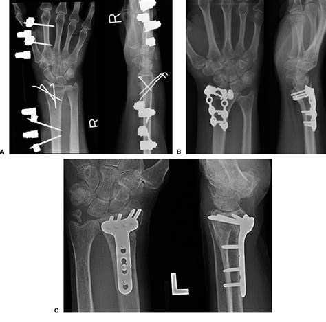 Figure 1 From Open Reduction Internal Fixation Versus Percutaneous Pinning With External