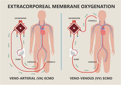 What Is Ecmo Doctors Are Shocked So Many Icu Patients Are On This