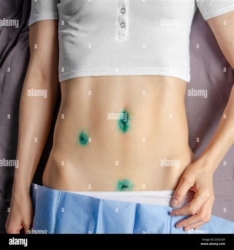 Open Appendectomy Scars