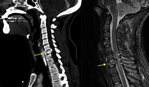 Cervical Spine Fracture X Ray Tolfquestions
