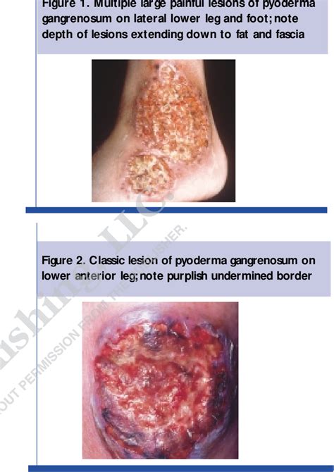 Figure 1 From Case Of The Month Januarys Diagnosis Pyoderma Gangrenosum Semantic Scholar