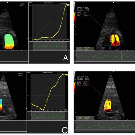 Comparison Of Ivpg And El In The Diastolic Period Of The Left Ventricle Download Scientific