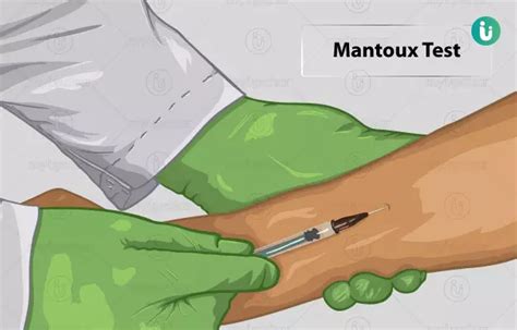 Mantoux Test Principle Procedure Interpretation And 60 OFF