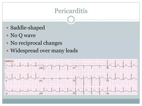 Interpretation Of Common Ecg Abnormalities PPTX