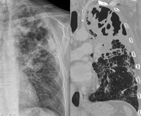 Necrotizing Pneumonia Radiology