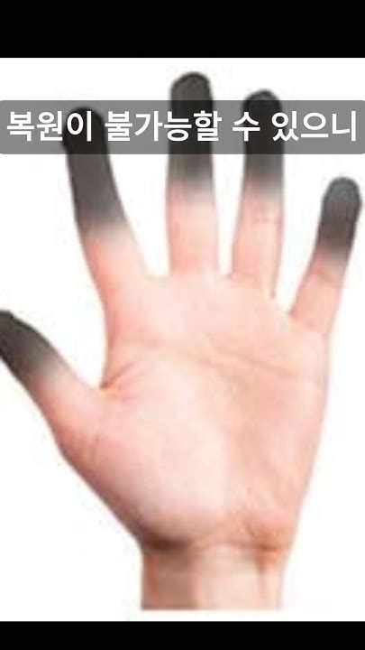 손가락을 살릴 수 있는 방법 Youtube