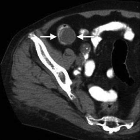Colonoscopy Smooth Round Projection Of The Base Of The Appendix Download Scientific Diagram