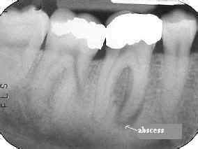 Periapical Abscess Radiograph