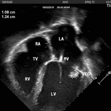 Transthoracic 2d Echocardiography At Presentation Showing Echo Dense Download Scientific