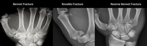 5th Metacarpal Base Fracture