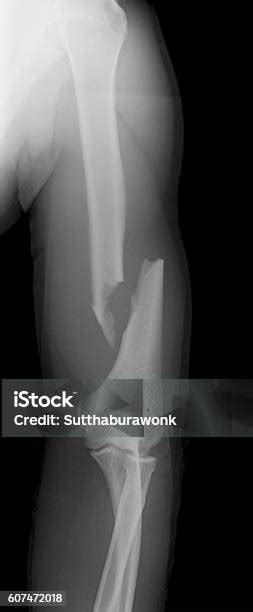 상완골 골절 엑스레이 이미지 X 레이에 대한 스톡 사진 및 기타 이미지 X 레이 갈비 음식 건강 진단 Istock