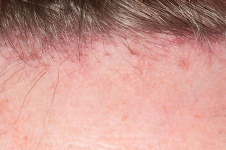 Early Stage Frontal Fibrosing Alopecia Symptoms Nlne