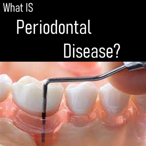 All About Periodontal Disease Dental Implant Center